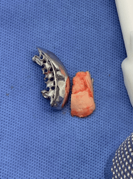 Hemi-Talus Implant | Ankle and Arthritis Centers