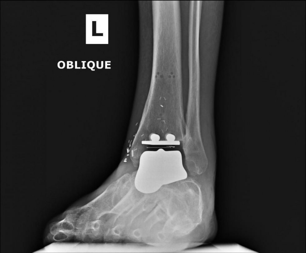 What is Avascular Necrosis (AVN)? | Ankle and Arthritis Centers